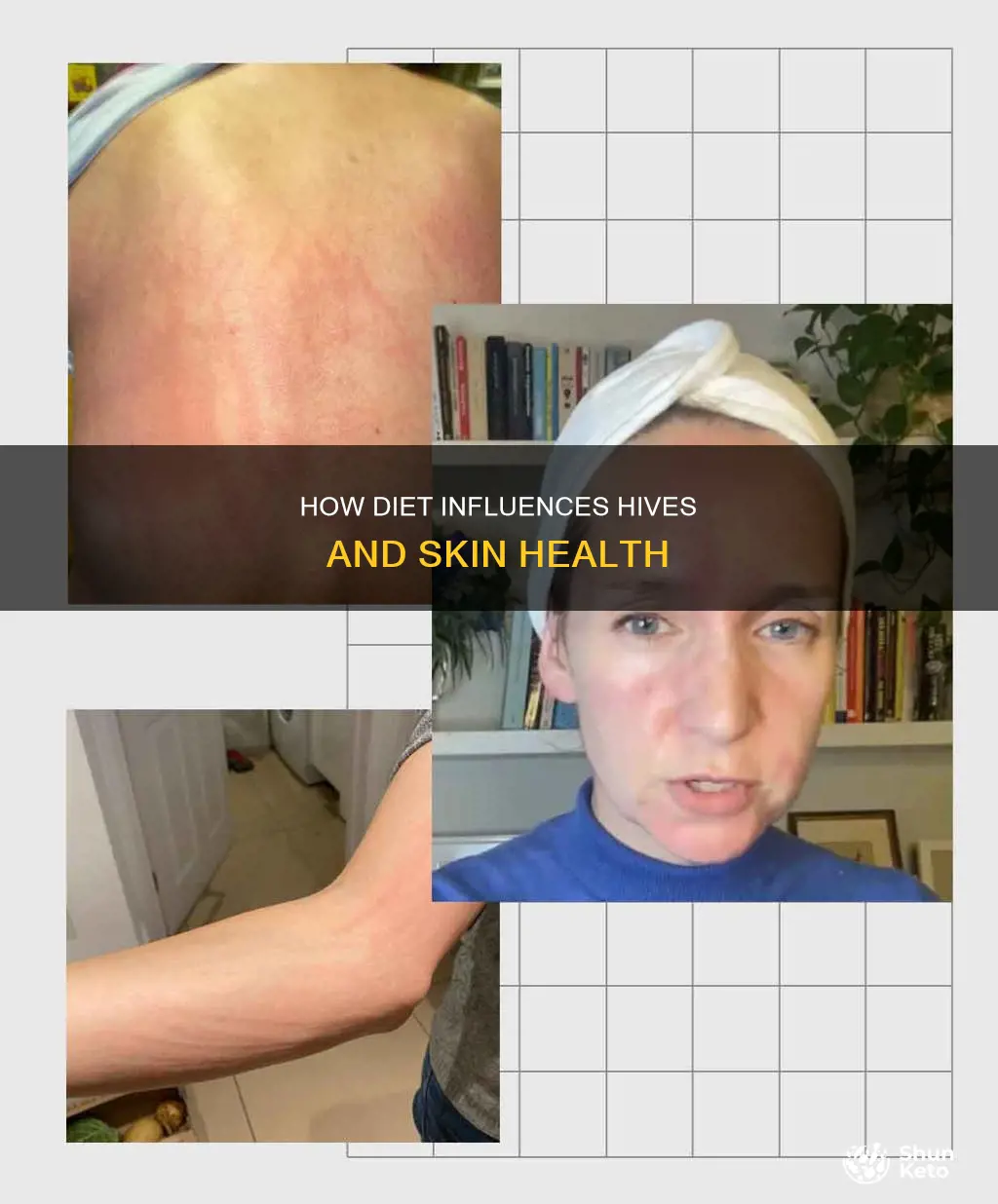 How Diet Influences Hives And Skin Health | ShunKeto