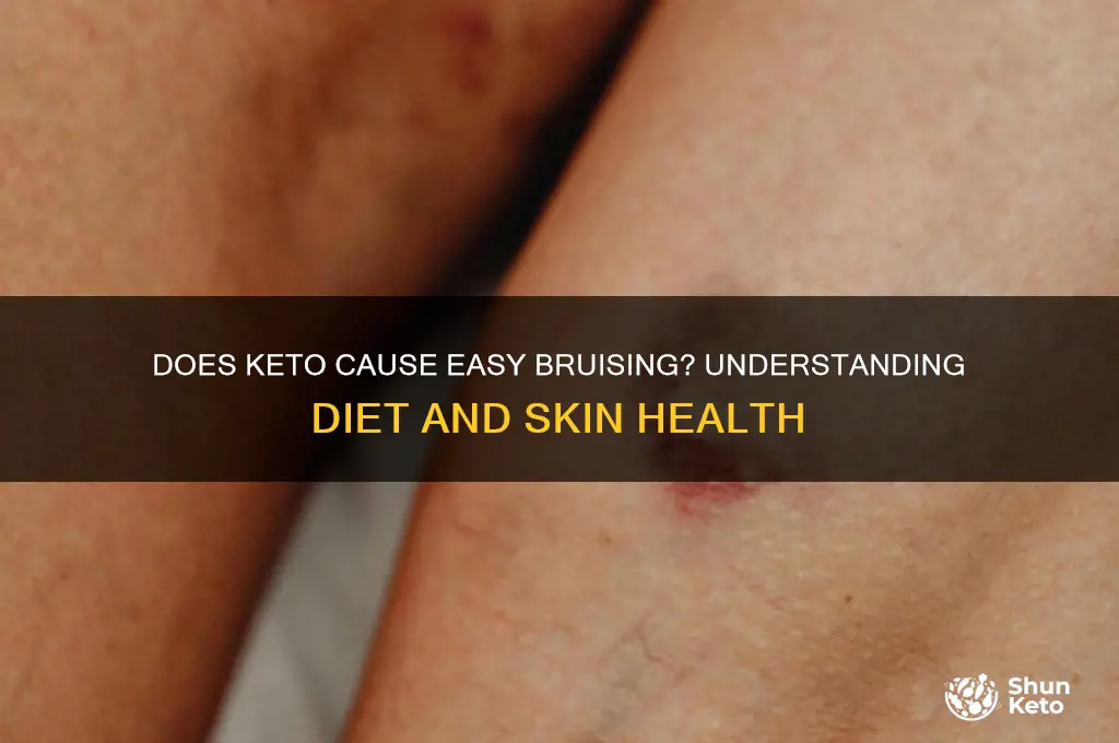 Does Keto Cause Easy Bruising? Understanding Diet And Skin Health ...