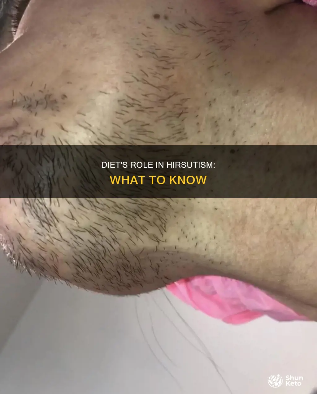 Diet's Role In Hirsutism: What To Know | ShunKeto