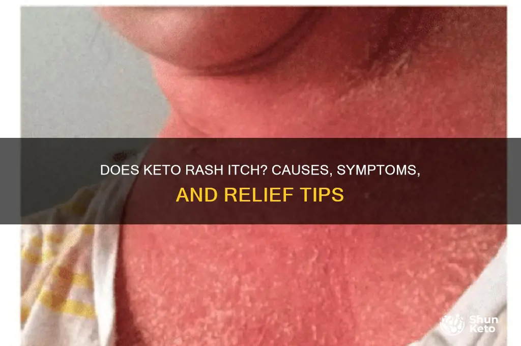 Does Keto Rash Itch? Causes, Symptoms, And Relief Tips | ShunKeto